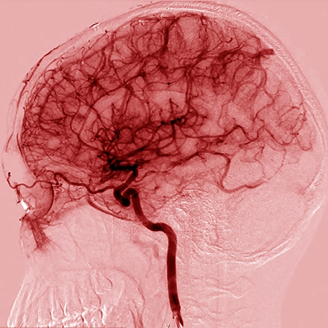 Acute Red Eye: Differential Diagnosis
